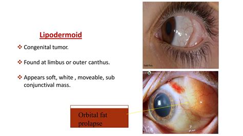 Anatomy Of Conjunctiva Ophthalmology Slides Pptx