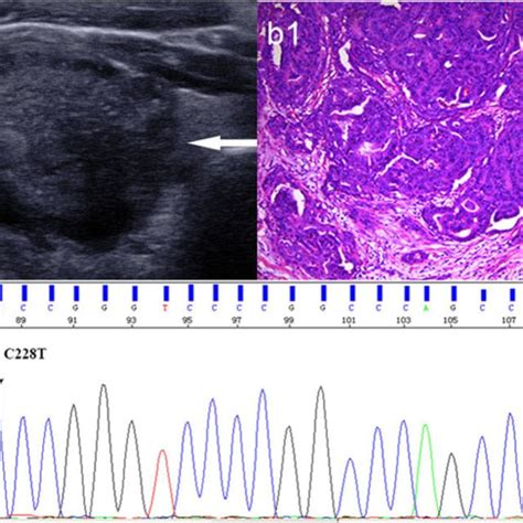 A Tert Promoter Mutations Papillary Thyroid Cancer In A 69 Year Old Download Scientific Diagram