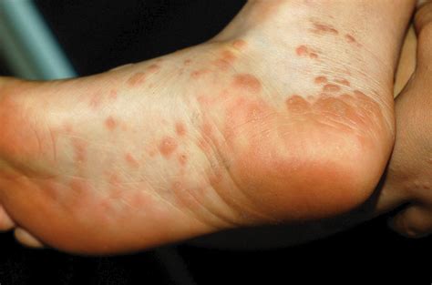 Various Sized And Shaped Erythematous To Violaceous Polygonal Papules