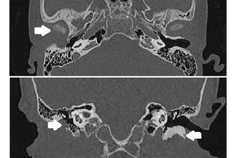 Temporal Bone Hrct Of Patient No 13 In The Axial And Coronal Sections