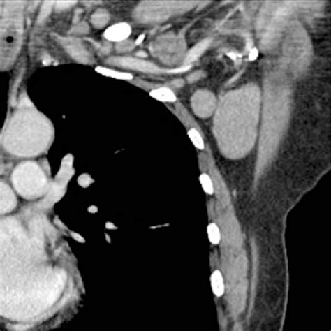 Figure 1 From Axillary Lymph Nodes From Morphology To Function