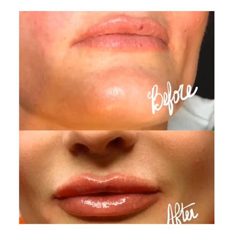 Geminifaces Volume Definition Shape Lip Fillers By Geminifaces
