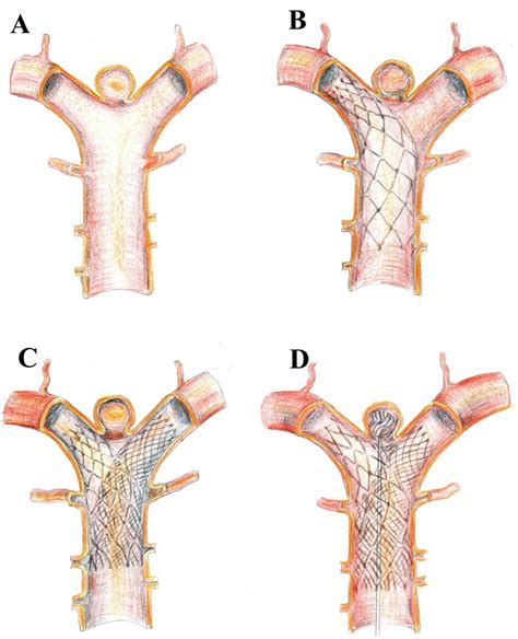 Stent Assisted Techniques For Intracranial Aneurysms Intechopen