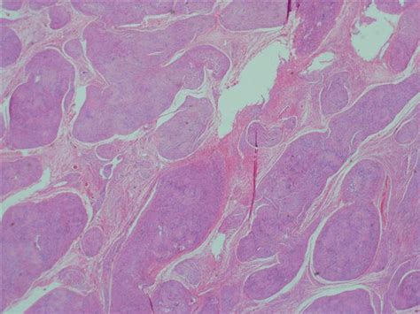 Plexiform Neurofibroma Histopathology