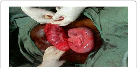 Clinical Aspect Of Ileo Ceco Colic Intussusception On Cecal Tumor