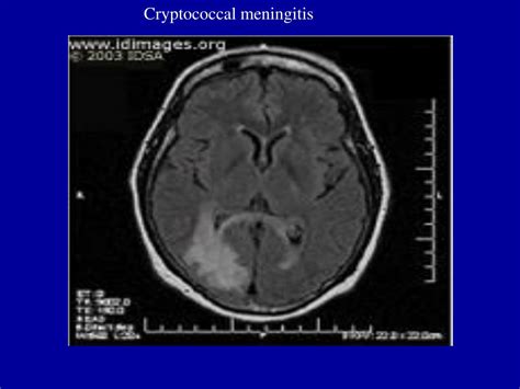 PPT Cryptococcus Neoformans And Other Yeast PowerPoint Presentation Free Download ID