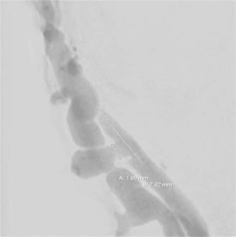Diagnostic Angiogram Demonstrates The Arteriovenous Fistula Avf Of Download Scientific