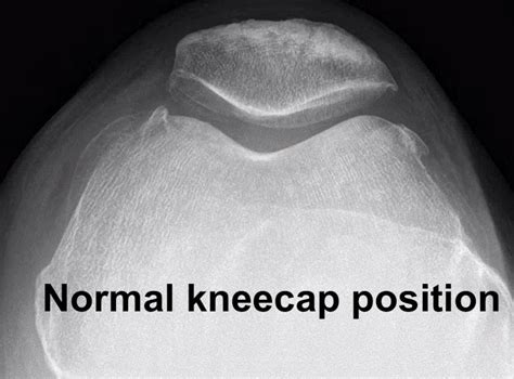 What Is A Patella Dislocation Alexlee
