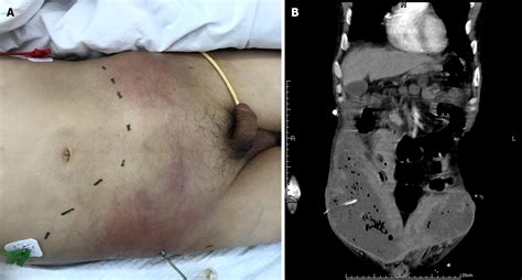 Anterior Abdominal Abscess A Rare Manifestation Of Severe Acute