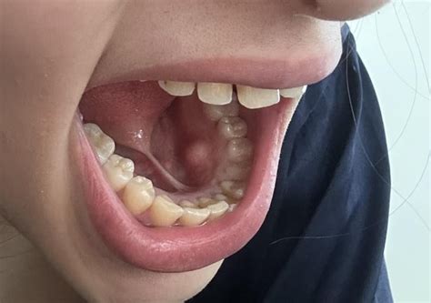 Hard Painless Lump On Lower Gum Near Floor Of Mouth Rdentalschool