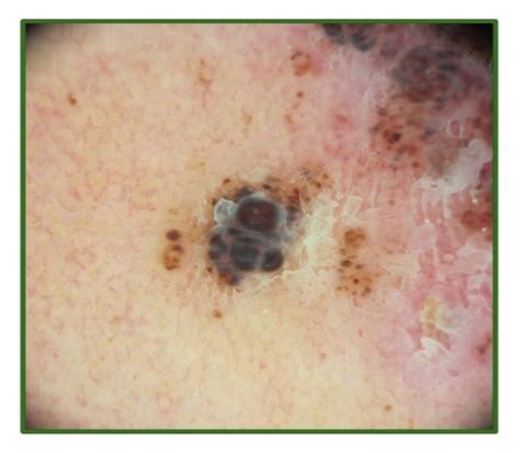 Genetic Algorithm Based Processing Of Dermatological Images Download Scientific Diagram