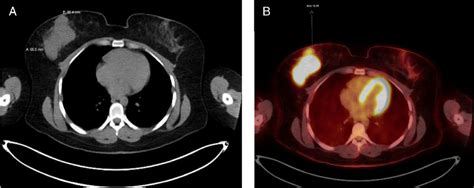 Breast Manifestation Of Extramedullary Myeloid Sarcoma A Case Report Semantic Scholar