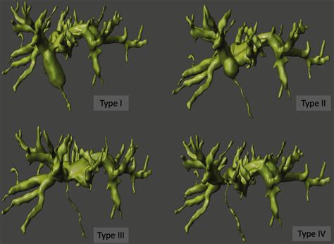 The Bismuth Classification For Biliary Strictures—3d Models Download