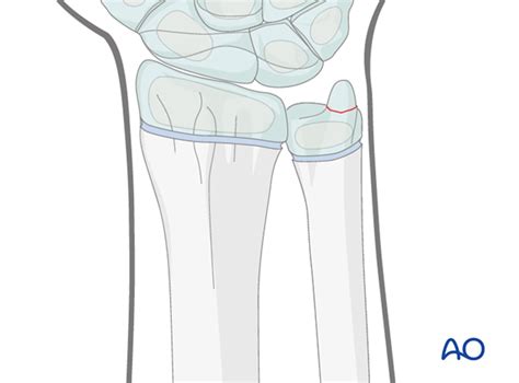 Splint For Avulsion Of The Styloid Ulna