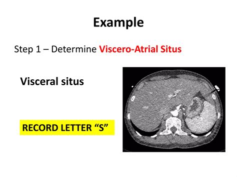 Sequential Segmental Analysis Of Heart Pptx
