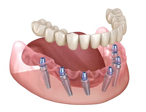 Full Mouth Dental Implants Houston Memorial Tanglewood Missing