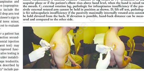 Demonstration Of A Subacromial Injection The Injection Is Made 1 Cm Download Scientific