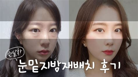 다크서클로 칙칙한 눈 눈밑지방재배치로 밝고 환한 여신 눈매 완성ㅣ아몬드성형외과 Youtube