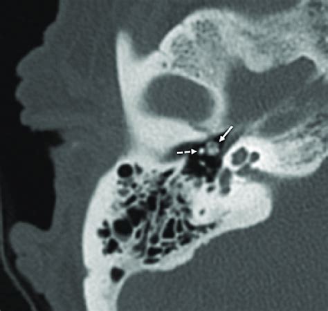 Noncontrast High Resolution Ct Scan Of The Right Temporal Bone Axial Download Scientific