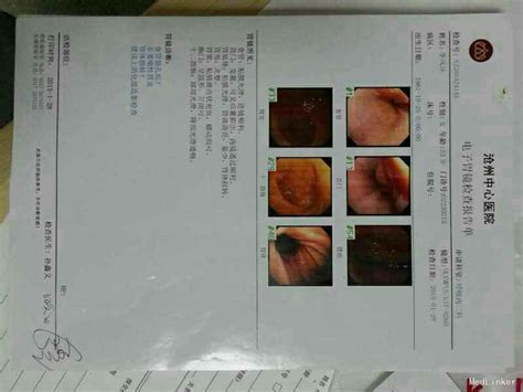 巨大食管裂孔疝行腹腔镜裂孔疝修补加Nissen胃底折叠术
