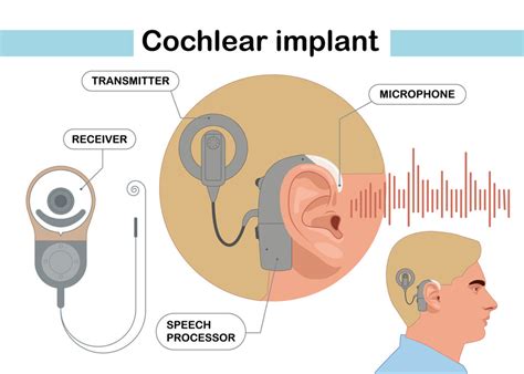 Cochlear Implants The Hearing Place