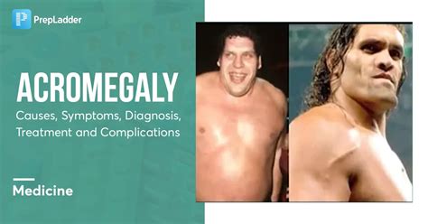 Acromegaly People Acromegaly People