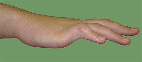 Pinky Finger Problems