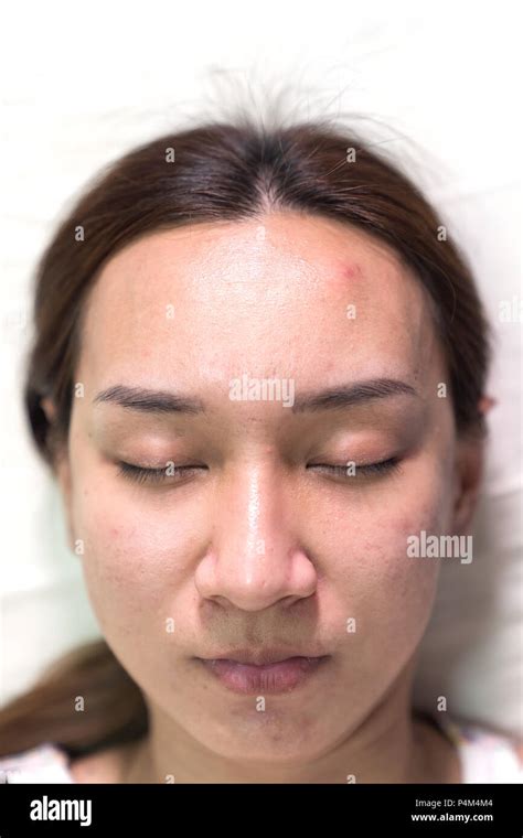 Pimples On The Forehead Hi Res Stock Photography And Images Alamy