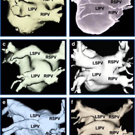 Anatomical Examination Of The Posterior La And The Pvs Shown Are