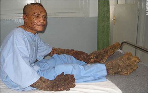 Tree Man Has Surgery Wants Love HuffPost Life