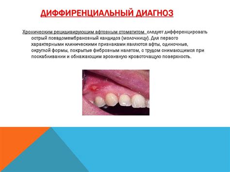 Кандидоз полости рта у детей Online Presentation