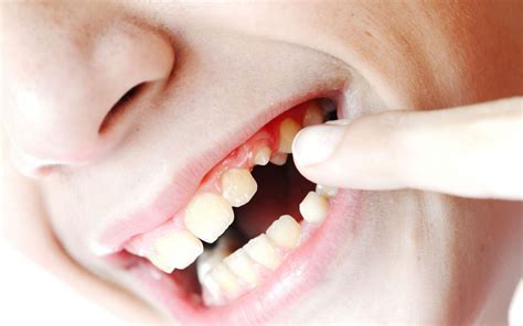 Broken Molar