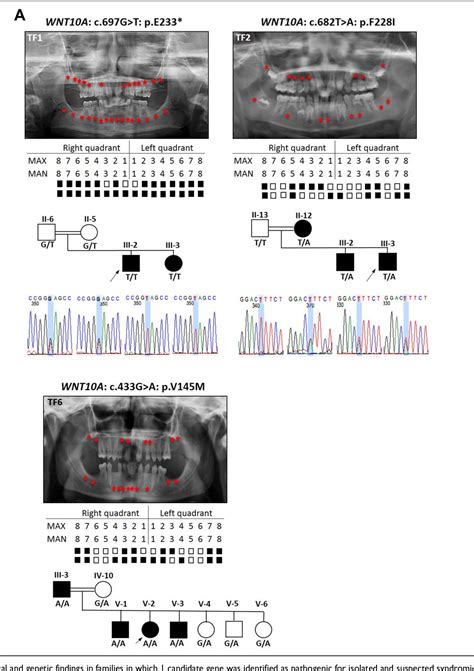 Table 1 From Whole Exome Sequencing Identifies Novel Variants For Tooth