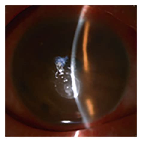 Case 2 A E Anterior Segment Photograph At Enrollment B F Download Scientific Diagram