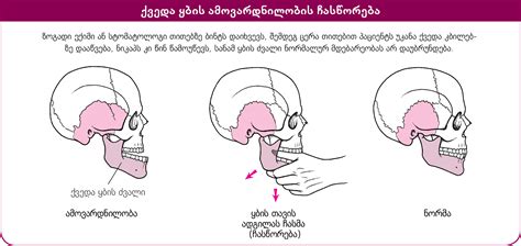 ქვედა ყბის ამოვარდნილობა მკურნალი გე