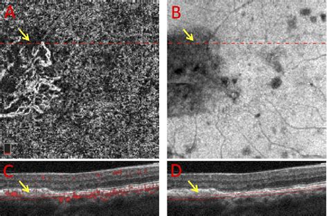 Octa And Structural Oct Of Exudative Cnv Eye Of Patient 3 Using 3 3 Download Scientific Diagram