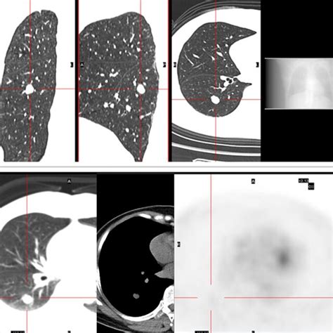 A Kind Of Round Nodular Opacity Was Observed In The Dorsal Segment Of A Kind Of Round Nodular Opacity Was Observed In The Dorsal Segment Of