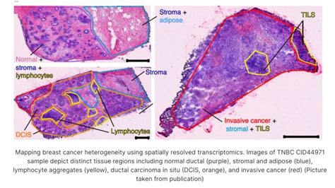 elucidata on linkedin spatialtranscriptomics spatial breastcancer