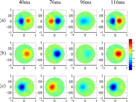 Figure 3 From Equivalent Dipole Sources Localization Using Cortical Dipole Layer Imaging And