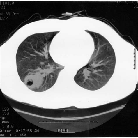TC Ad Alta Risoluzione HRTC Dopo 1 Mese Di Terapia Completa Download Scientific Diagram
