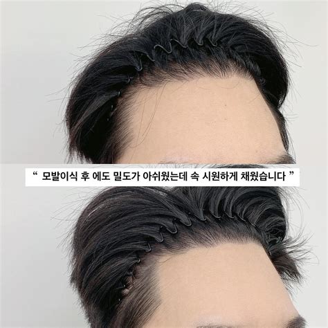 훈썹브로우 • 훈쌤이 그려주는 훈훈한 눈썹 맨즈헤어라인 🧔🏻‍♂️모발이식 후 밀도보완 최근 모발이식 후 밀도보완 문의가 많습니다 🙏 생착률의 아쉬운 부분과 이식하는