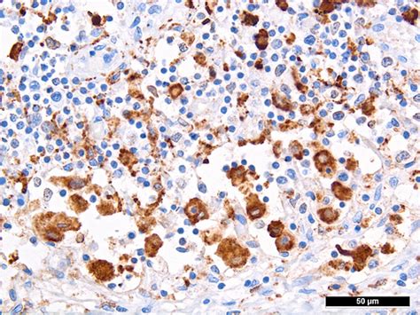 Figure S2 Haemophagocytosis In Sinus Of A Paratracheal Lymph Node