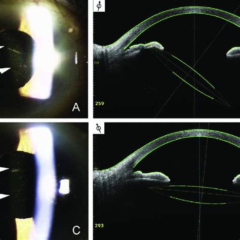 PDF Adjustments Of Haptics Length For Tilted Intraocular Lens After Intrascleral Fixation