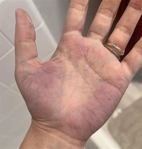 Does This Look Like Raynauds Rraynauds Does This Look Like Raynauds Rraynauds
