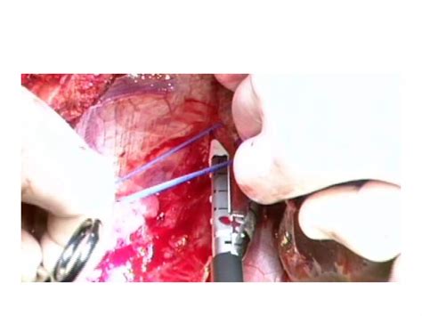 Right Hepatectomy Step By Step Description For Surgeon Pptx