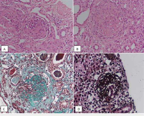 Class Iii Lupus Nephritis A B Hematoxylin And Eosinstained Sections