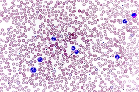 Neutrophilia An Overview Sciencedirect Topics 55 Off