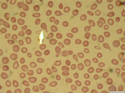 What Is The Significance Of Teardrop Cells Dacrocytes On The
