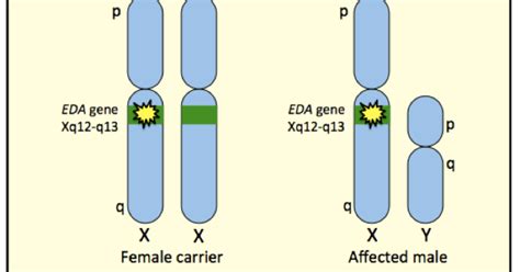 Ectodermal Dysplasia Image