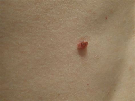 Cutaneous Papilloma Symptoms Images Ai Analysis 🟢 Icd 10 D23 Icd